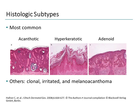 Why Seborrheic Keratosis Should Be on Your Radar (Transcript)