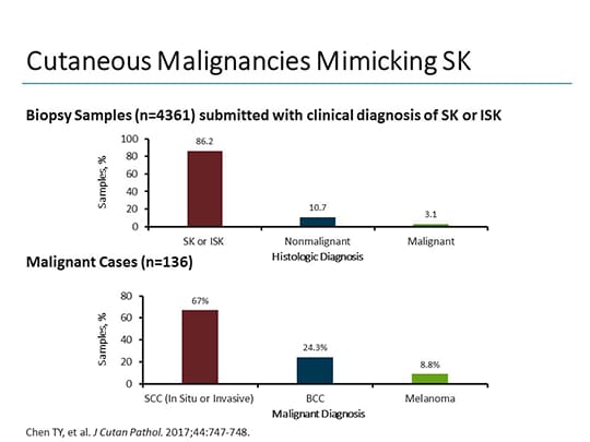 Why Seborrheic Keratosis Should Be on Your Radar (Transcript)
