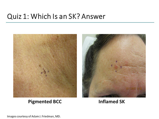 Why Seborrheic Keratosis Should Be on Your Radar (Transcript)