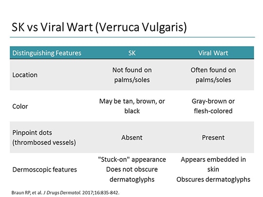 Why Seborrheic Keratosis Should Be on Your Radar (Transcript)