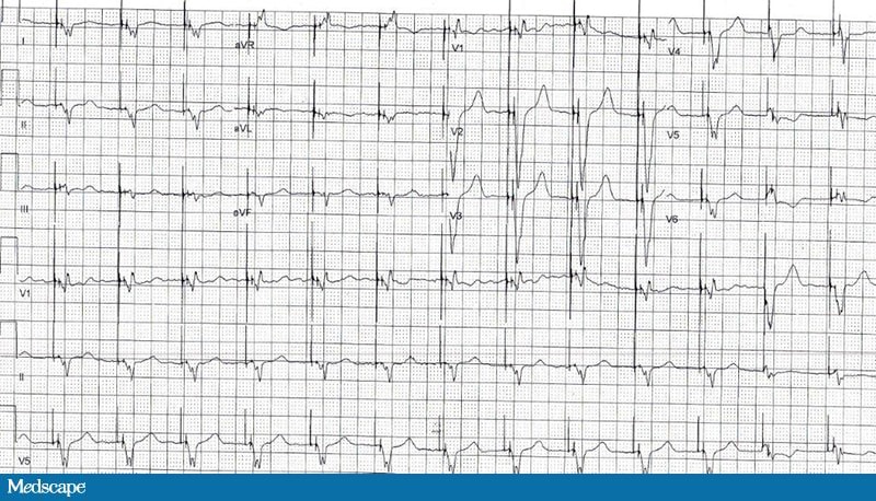 ECG Challenge: What Does This Tracing Reveal About the Pacing?