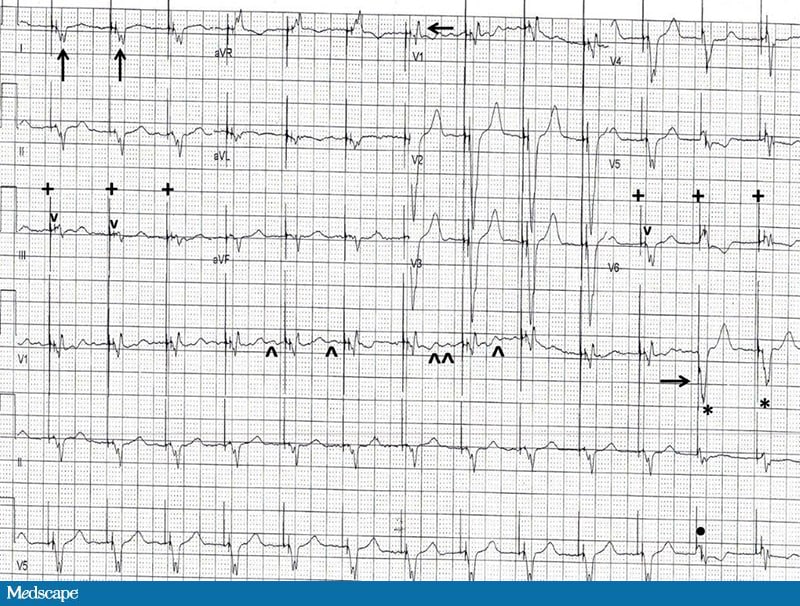 ECG Challenge: What Does This Tracing Reveal About the Pacing? - Page 2