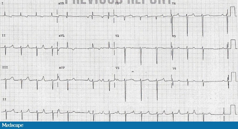 ECG Challenge: A Swimmer With an Irregular Pulse