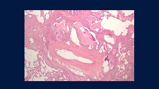 Updates in Idiopathic Pulmonary Fibrosis: Real-World Data and Emerging ...