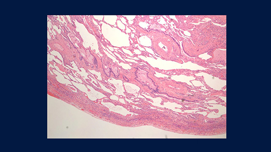 Updates in Idiopathic Pulmonary Fibrosis: Real-World Data and Emerging ...