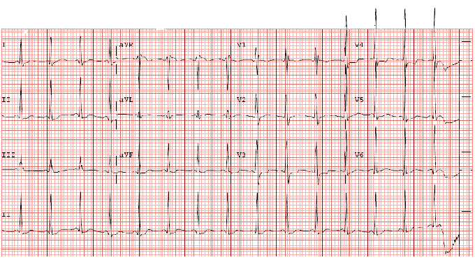 Clinical Updates on Fabry Disease: Diagnosis Through Treatment