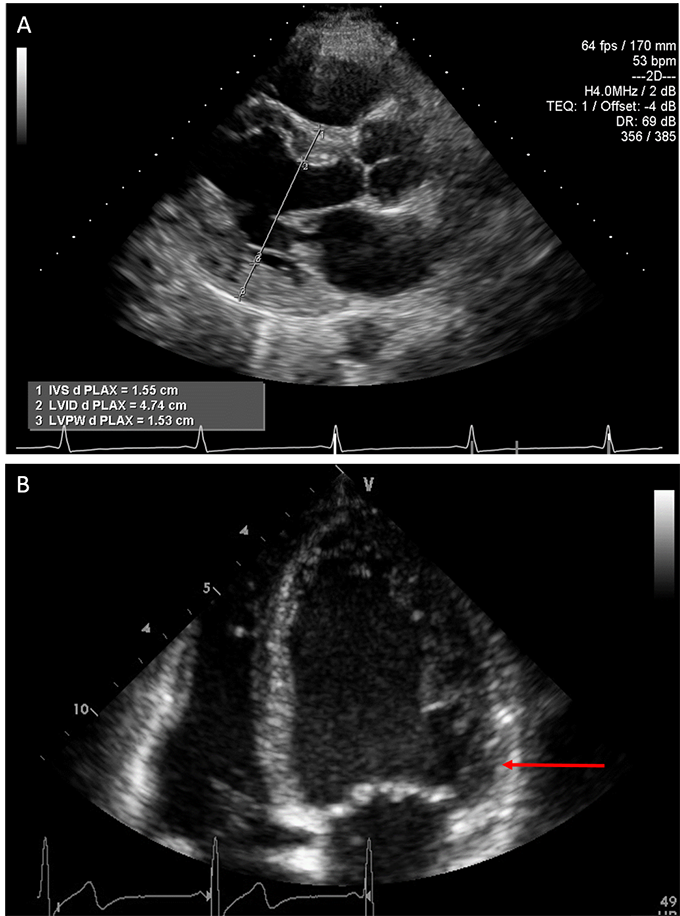 Clinical Updates on Fabry Disease: Diagnosis Through Treatment