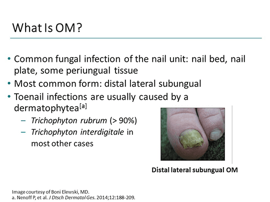 Ask the Onychomycosis Expert: Part 1-Tips for Primary Care Physicians ...