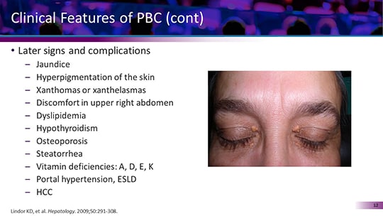 Solving the PBC Mystery: From Missing Clues to Diagnosis and Improved ...