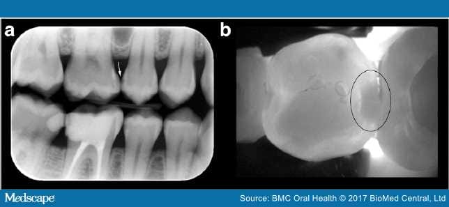 Diagnosis of Early Interproximal Caries With NILT - Page 3