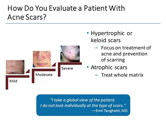 Acne Scars Run Deep: Effective Approaches for Patients at Risk