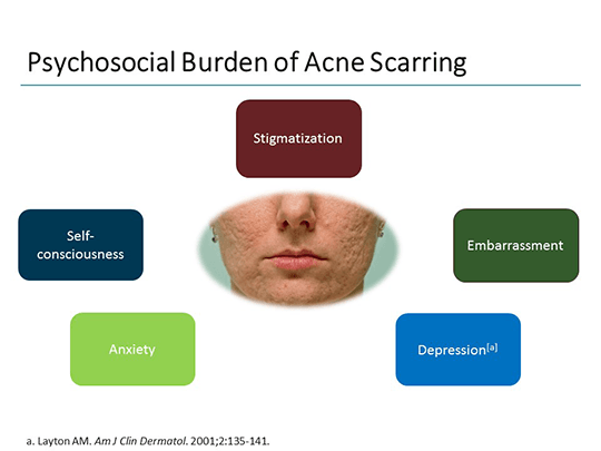 Acne Scars Run Deep: Effective Approaches for Patients at Risk