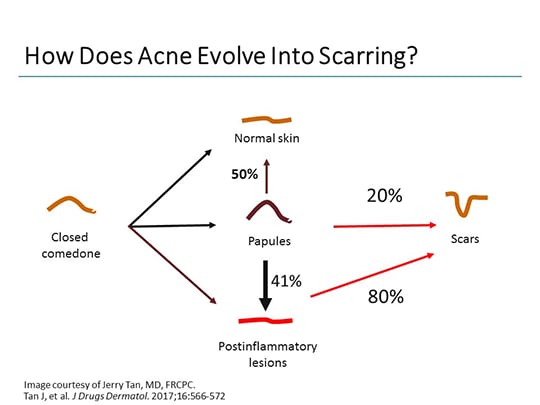 Acne Scars Run Deep: Effective Approaches for Patients at Risk