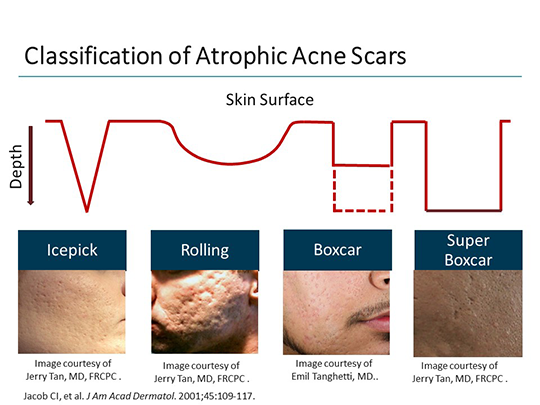 Acne Scars Run Deep: Effective Approaches for Patients at Risk