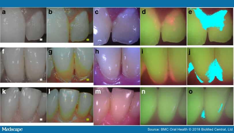 A Fluorescent Imaging System for Detection of Dental Plaque - Page 4