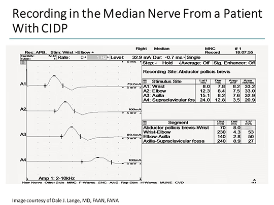 Moving the Needle in CIDP: Optimizing Treatment Decisions