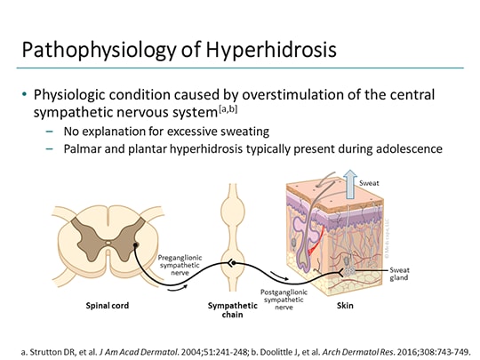 Hyperhidrosis Is Burdensome! How to Diagnose It Sooner