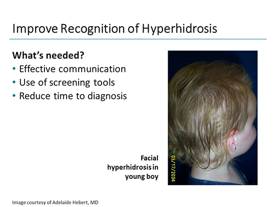 Hyperhidrosis Is Burdensome! How to Diagnose It Sooner