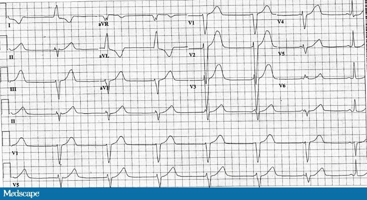 ECG Challenge: What Is This Post-Stenting Rhythm?