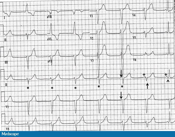 ECG Challenge: What Is This Post-Stenting Rhythm? - Page 2