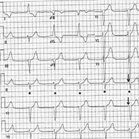 ECG Challenge: What Is This Post-Stenting Rhythm? - Page 2