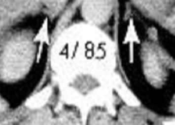A 67-Year-Old Woman With Orthostatic Hypotension and Edema - Page 2