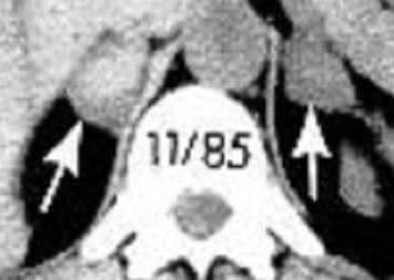 A 67-Year-Old Woman With Orthostatic Hypotension and Edema - Page 2