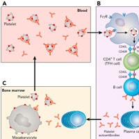 Splenectomy for Immune Thrombocytopenia: Down But Not Out