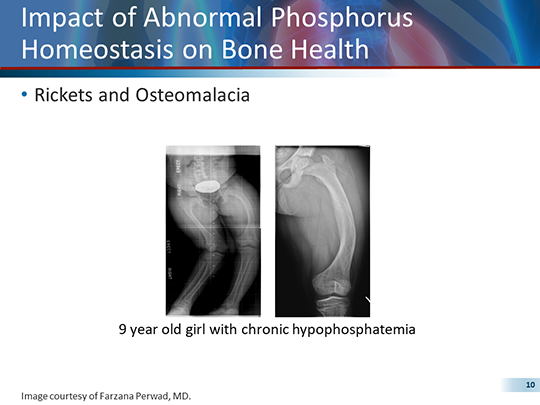 Hereditary Hypophosphatemia: Diagnostic Challenges and Potential New ...
