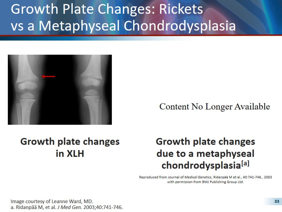 Hereditary Hypophosphatemia: Diagnostic Challenges and Potential New ...