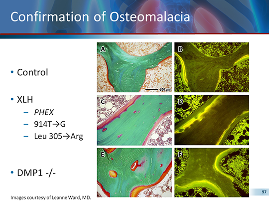 Hereditary Hypophosphatemia: Diagnostic Challenges and Potential New ...