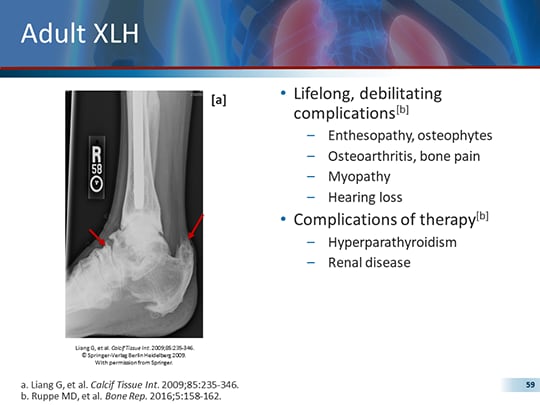 Hereditary Hypophosphatemia: Diagnostic Challenges and Potential New ...