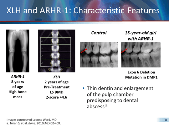 Hereditary Hypophosphatemia: Diagnostic Challenges and Potential New ...
