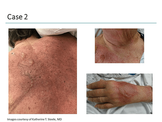 Clinical Pearls on the Management of Immune-Mediated AEs Affecting the Skin