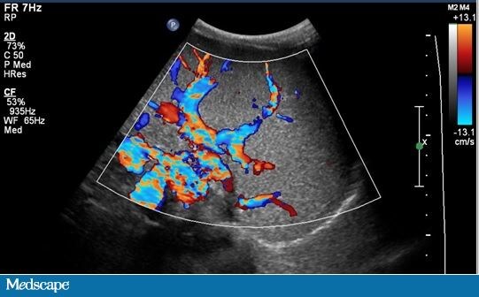 Chronic Splenomegaly in a 10-Year-Old Boy - Page 2