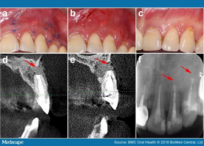 Periapical Microsurgery With the Aid of 3D Technology - Page 3