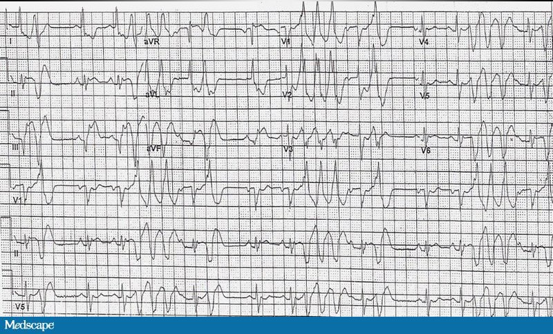 Crushing Chest Pain: What Does His ECG Show?