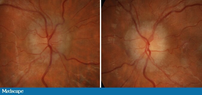 Are These Ocular Symptoms Common or Concerning? - Page 2