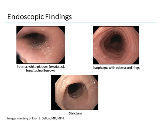 Ask the Experts: Guidelines and Emerging Advances for Treatment of Eosinophilic Esophagitis