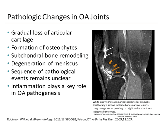 Perspectives on the Impact of Inflammation in Osteoarthritis: Current ...