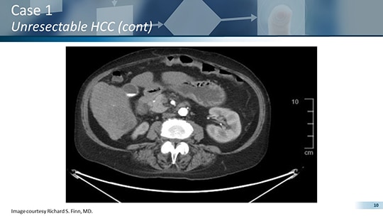 A Master Class on Treating Unresectable HCC: Is There a Right Sequence?