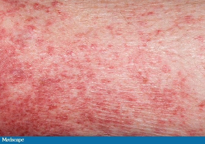 Bleeding Gums and Rash on Both Legs in a 38-Year-Old Man