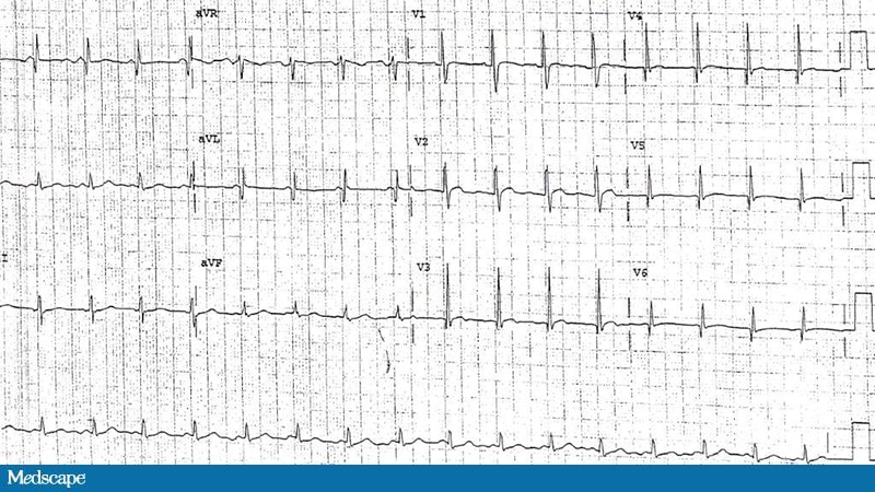 The Telltale Tall R Waves