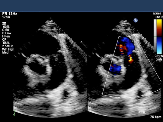 Echo Case: Four of a Kind