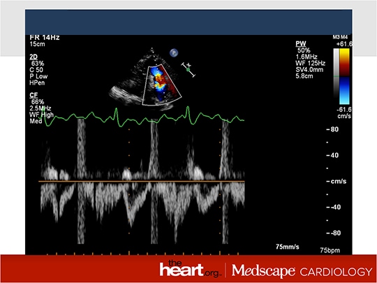 Echo Case: Four of a Kind
