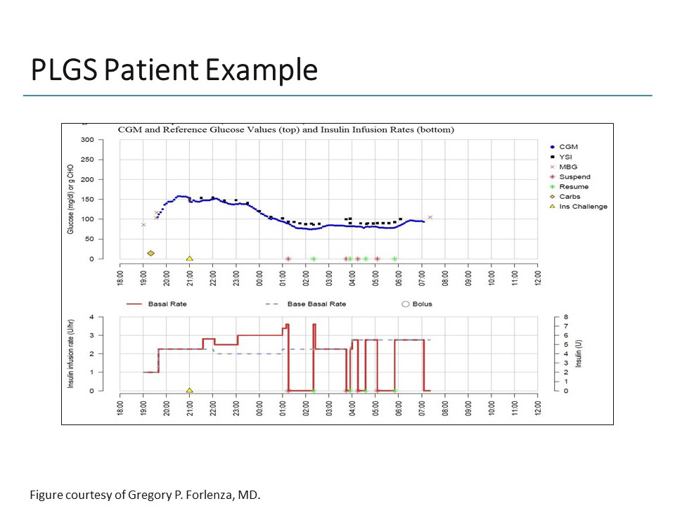 Predictive Low Glucose Suspend (PLGS): Future of Diabetes Management ...