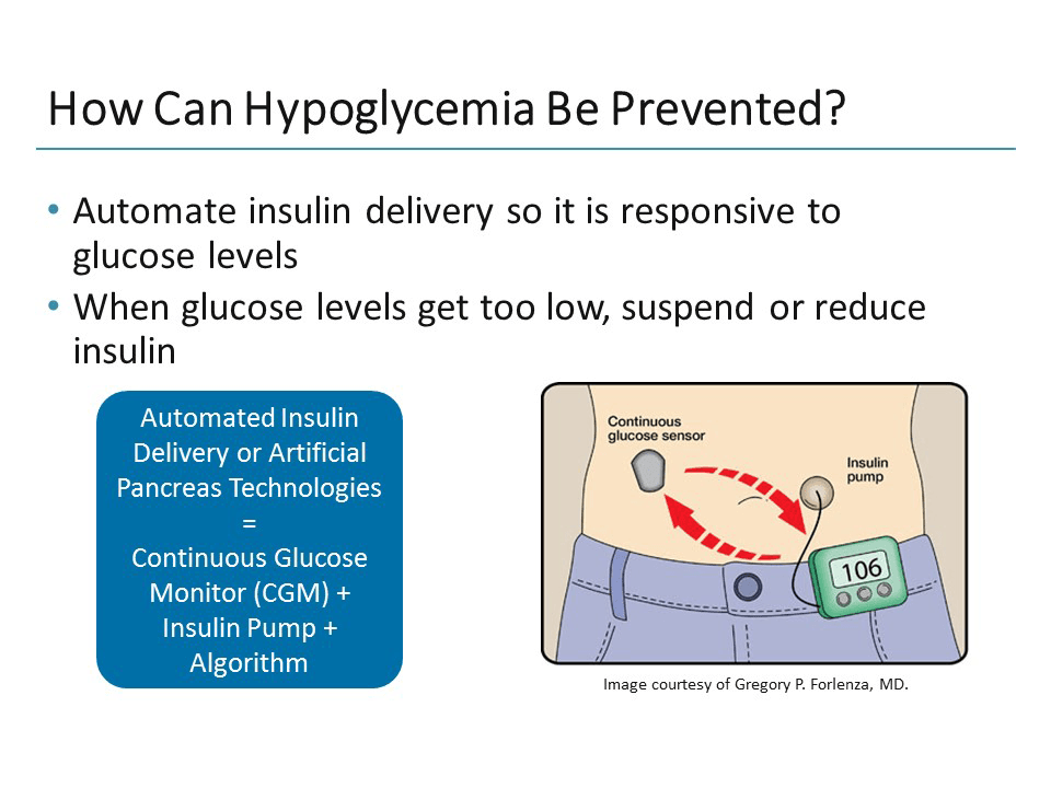 Predictive Low Glucose Suspend (PLGS): Future of Diabetes Management ...