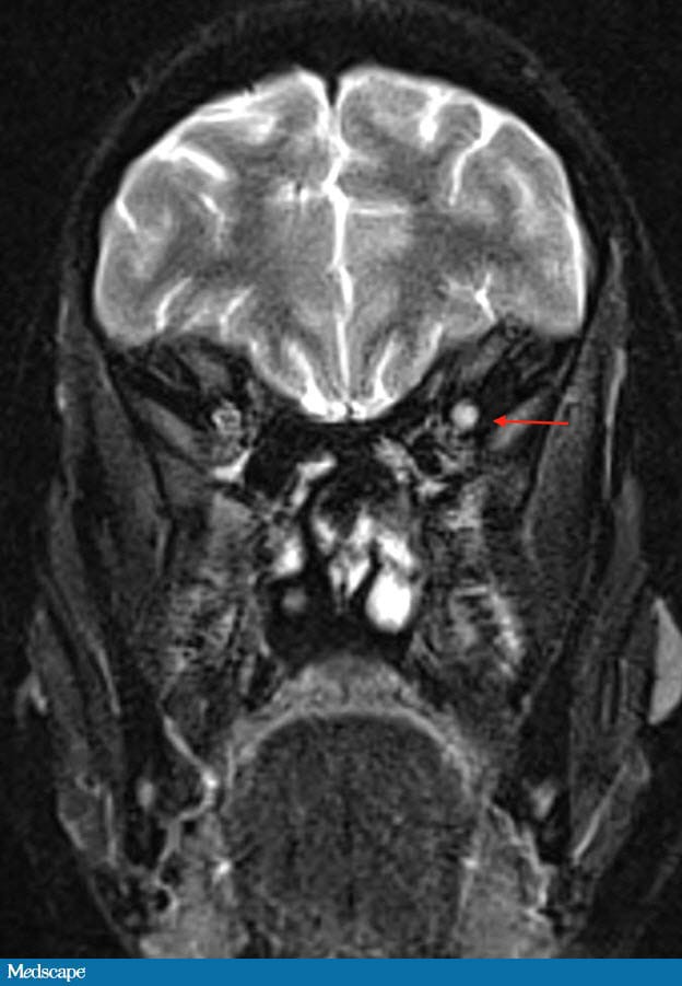 Does a Patient's Blurry Vision Signal a Serious Condition? - Page 2