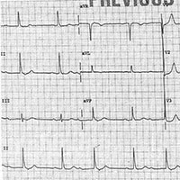 ECG Challenge: A Counterclockwise Rotation