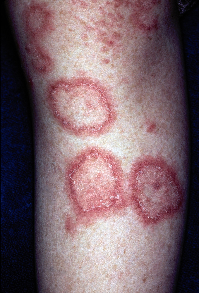 Specialist Perspectives on SLE Management: Approaches to Integrating Care